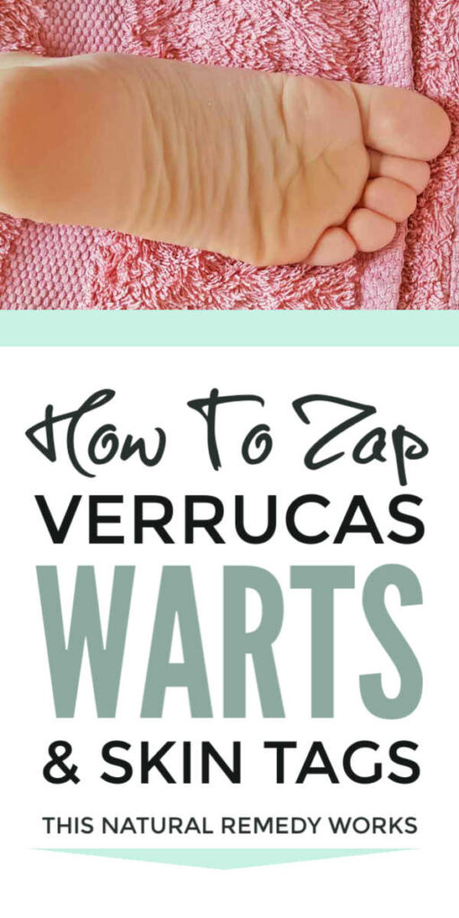 Get Rid of Verrucas Naturally